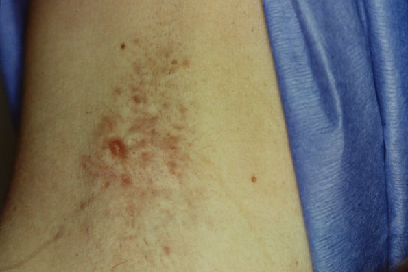 PICT0010 | Non_infectious granuloma | Dr. Ken Hashimoto | Wayne State University SOM ...